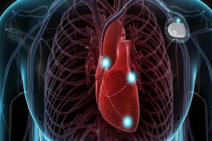 Understanding AICD: Device for Treating Ventricular Arrhythmias and ...